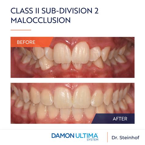 Class Ii Sub Division 2 Malocclusion With Significant Maxillary And