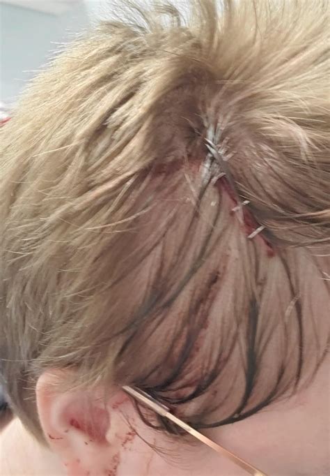 Scalp Laceration Healed Photo Included R Nsfl