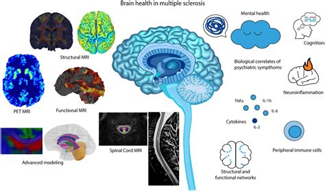 Understanding Multiple Sclerosis Ms Unraveling The Complexities Of An Autoimmune Disorder