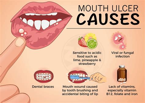 Anemia Symptoms Mouth Ulcers