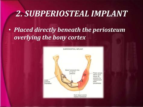 Types And Classification Of Dental Implants Pptx Operating Systems Computer Software And