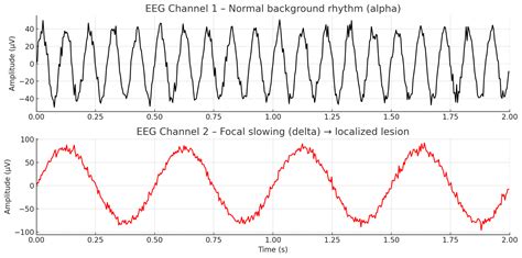 Electroencephalography Eeg Interpretation And Clinical Use The Anesthesia Guide
