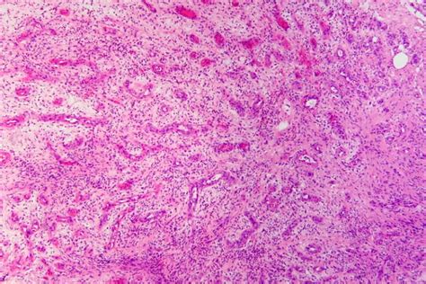 Difference Between Epithelialization And Granulation Compare The