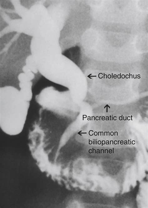 Choledochal Cyst And Gallbladder Disease Clinical Tree