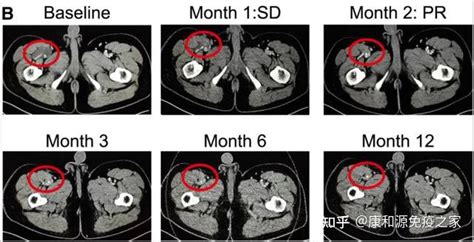 重磅！全球首款tcr T细胞疗法获批上市！肿瘤缩小81 ！ 知乎