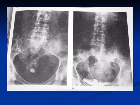 Urinary Outflow Obstruction Ppt