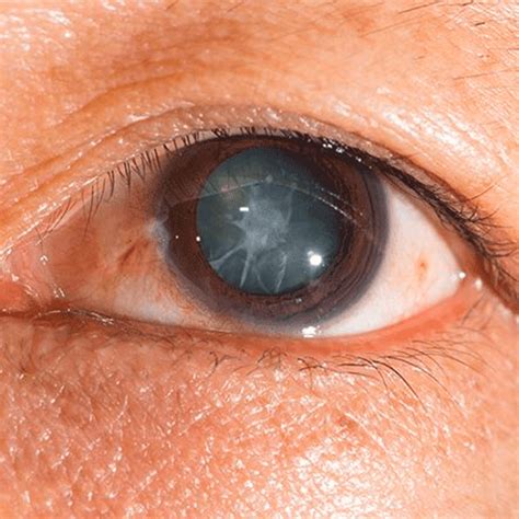Cataract Symptoms Causes And Treatments By Vasan Eye Care