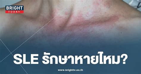 ทำความเข้าใจ โรค Sle หรือ โรคแพ้ภูมิตัวเอง มีอาการอย่างไร