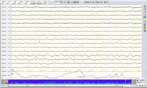 Interictal Scalp Eeg Showing Frequent Isolated Spikes And Sharp Waves Download Scientific