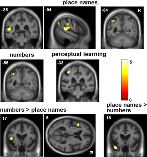 Voxel Based Morphometry Results Statistical Parametric Maps Of