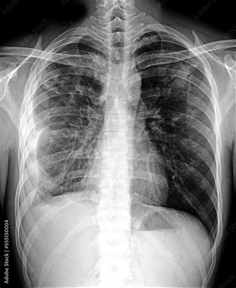 Bronchiectasis X Ray Chest Show Multiple Lung Bleb And Cyst Due To Chronic Infection Stock