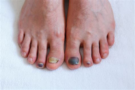 White Patches On Toenails Causes Signs And Best Treatment