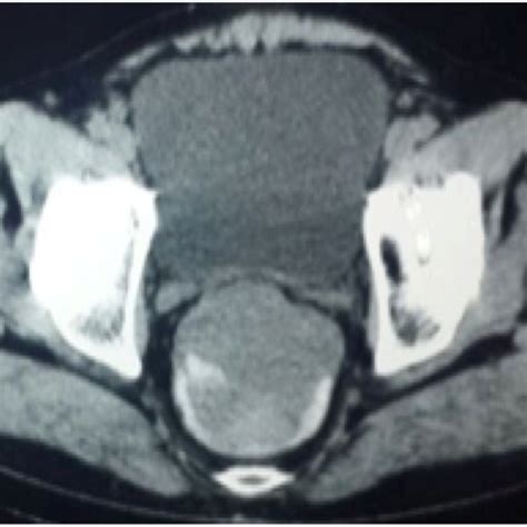 Preoperative Ct Scan Of Rectal Gist Download Scientific Diagram Preoperative Ct Scan Of Rectal Gist Download Scientific Diagram