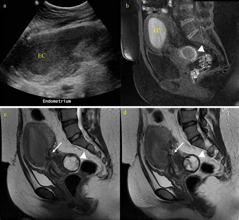 Cervical Stenosis In A 36 Year Old With Secondary Amenorrhea After Open