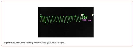 Ventricular Tachycardia Following Mannitol Induced Hyperkalemia A Case