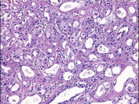Adenosis And Sclerosing Lesions Oncohema Key