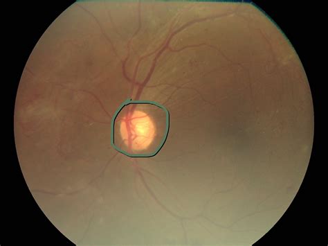 What Is Neovascularization Of The Disc Or Nvd Advanced Retina Care