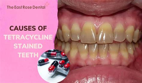 Understanding Tetracycline Stained Teeth And Effective Treatment Methods