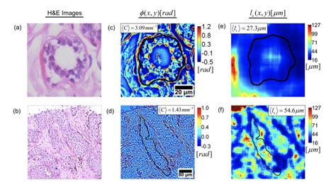 Label Free Quantitative Evaluation Of Breast Tissue Using Spatial Light Interference Microscopy