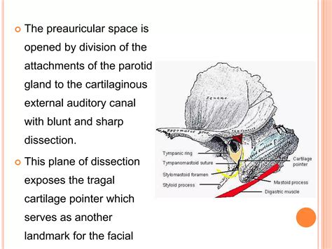 Parotidectomy Pptx