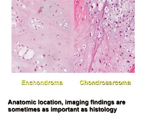 Enchondroma Histology