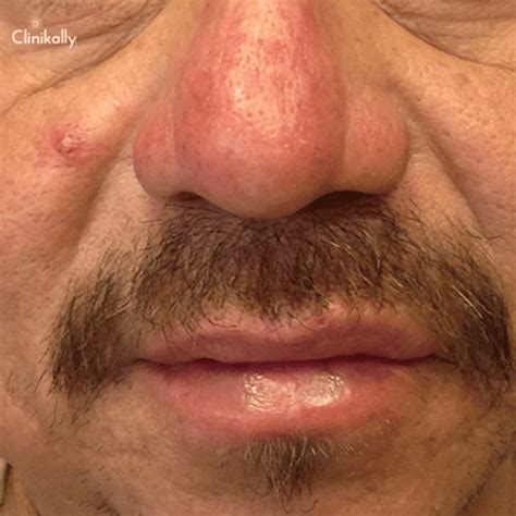 Rhinophyma Nose Swelling Causes And Treatment Options Clinikally