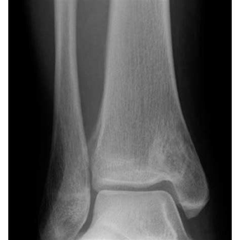 Intraosseous Ganglion Of The Distal Tibia In A 37 Year Old Woman Plain Download Scientific