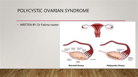 Pcos Presentation Pptx