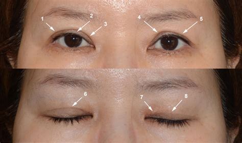 쌍꺼풀 재수술의 생명은 Detail이다 네이버 블로그