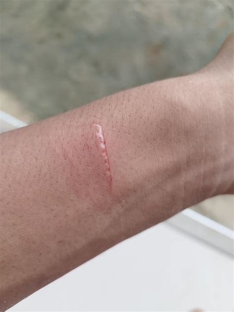 Should I Need A Tetanus Shot Rwoundcare