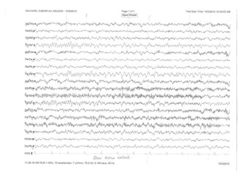 Eeg Variants With Patterns By Murtaza Syed