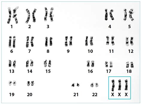 Triple X Syndrome