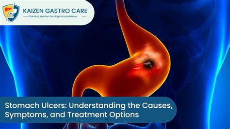Stomach Ulcers Understanding The Causes Symptoms And Treatment