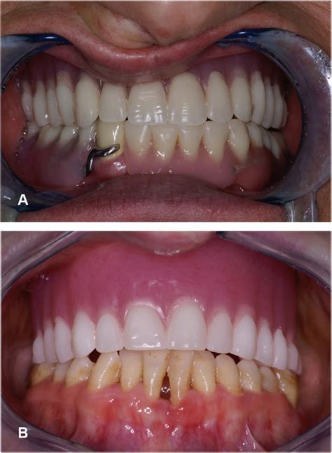 Finished Maxillary Obturator Prostheses A Total Maxillectomy Patient Download Scientific