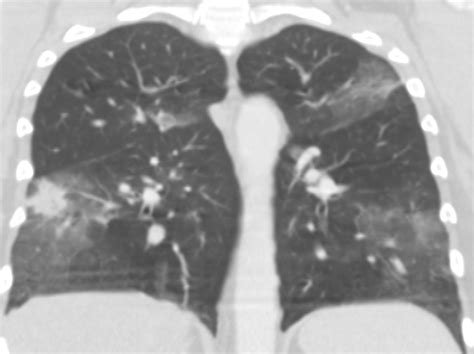 Thorax Radiology Assistent E