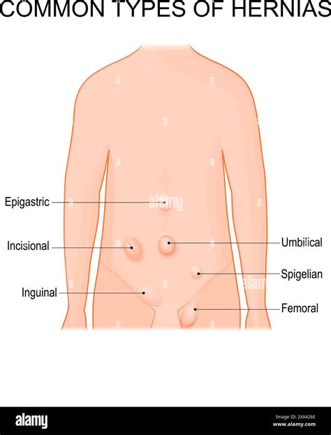 Hernia Types Common Sites For Hernias Schematic Diagram Detailed