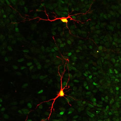 Huntingtons Disease How Could Stem Cells Help Eurostemcell