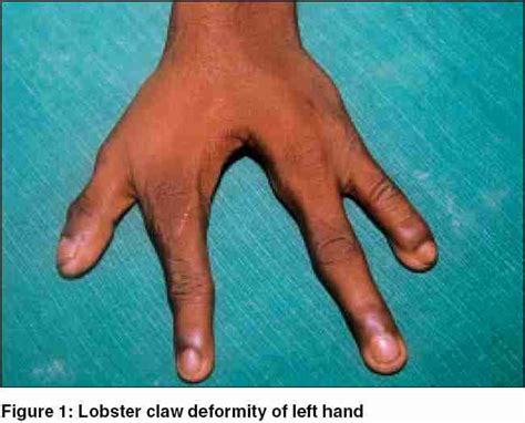 Ectodermal Dysplasia Hands