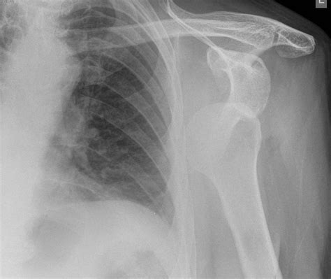 Anterior Shoulder Dislocation With Fracture Buyxraysonline