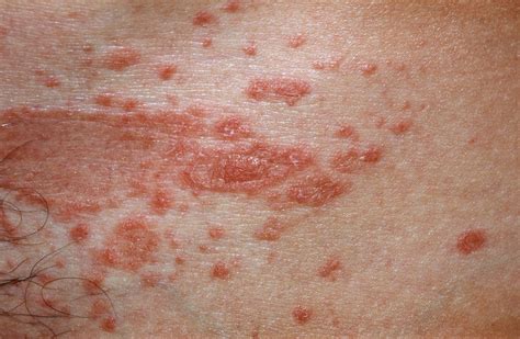 Pityriasis Rosea Causes Rash Herald Patch Stages Treatment