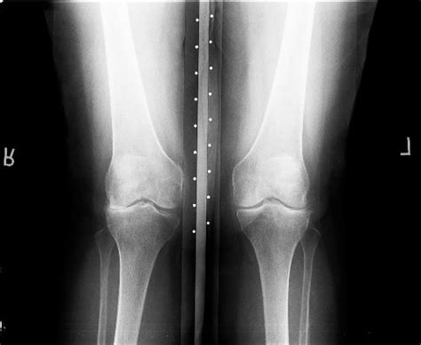 knee joint localization 7shot object detection dataset by kneejointlocalizationjan2023