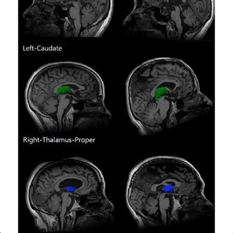 Subcortical Nuclei With Differences In The Two Groups Brain