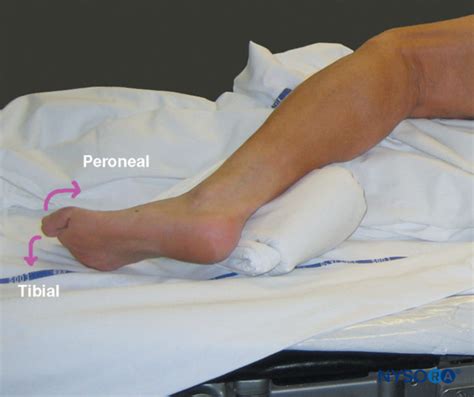Sciatic Nerve Block Landmarks And Nerve Stimulator Technique Nysora