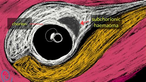 Early Pregnancy Ultrasound Explained Amnion And Chorion Youtube