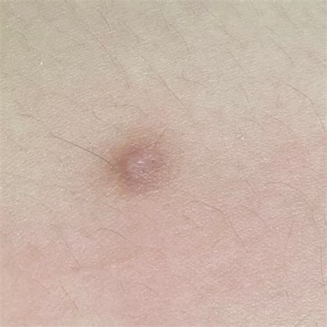 다리에 종기 지식in