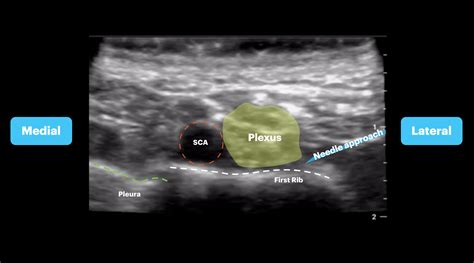 Brachial Plexus Upper Extremity Nerve Blocks Image Atlas — Tpa
