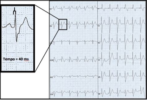 Como Diferenciar Uma Taquicardia De Qrs Largo Usando Apenas Dii