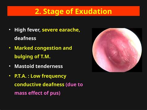 Acute Suppurative Otitis Media And Acute Mastoiditis Kkppt