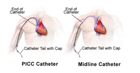 Central Line Catheters Flashcards Quizlet