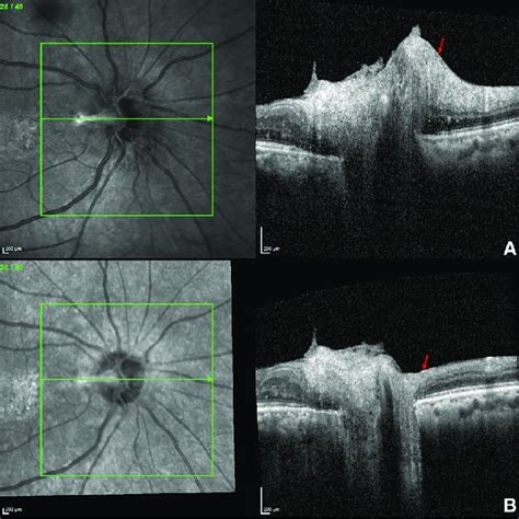 Spectral Domain Optical Coherence Tomography Sd Oct Of Retinal Nerve Download Scientific